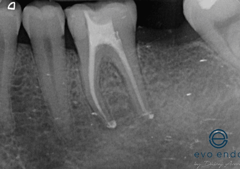 Case study 1: LL6 RCT - Evo Endo by Dr Dhiraj Arora