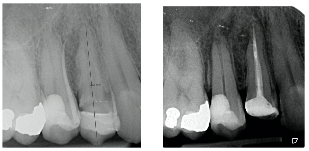 In favour of pre-endodontic build-up - Evo Endo by Dr Dhiraj Arora